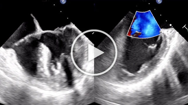 Video gallery – Minicardiac Surgery Ancona